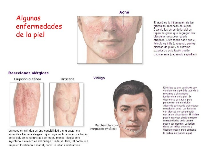 Estas Son Las Principales Enfermedades De La Piel Chapintv