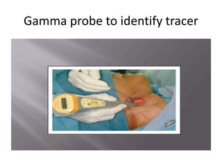 Sentinal lymph node biopsy | PPTX
