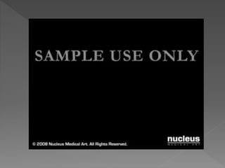 Sentinel lymph node biopsy (slnb) | PPTX