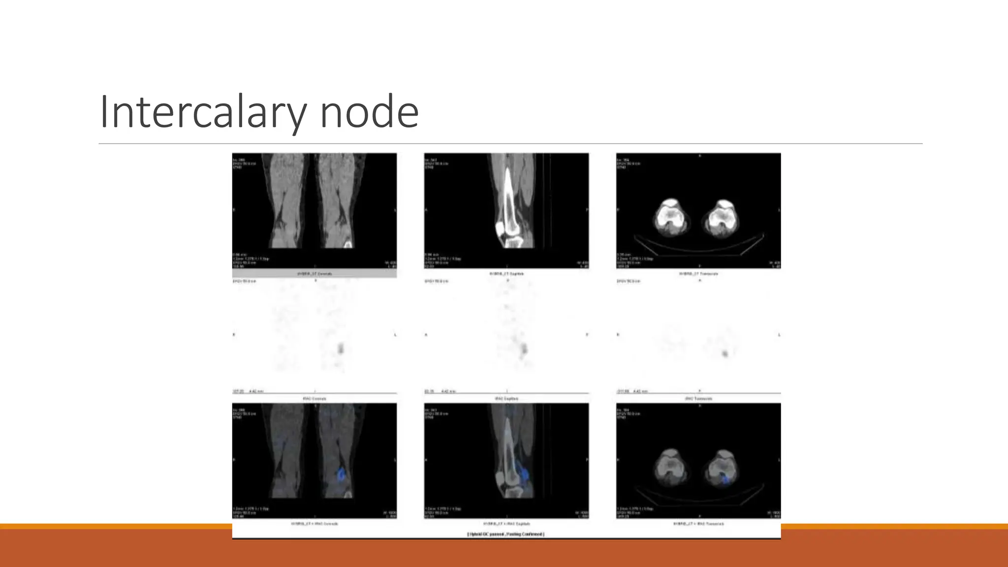 Sentinel node biopsy in oncology a breif overview | PPTX