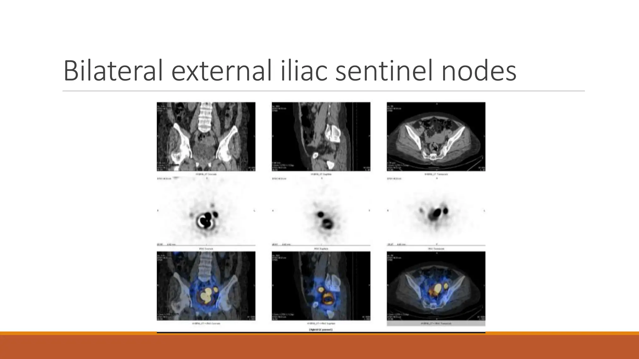 Sentinel node biopsy in oncology a breif overview | PPTX