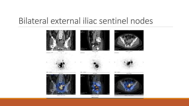 Sentinel node biopsy in oncology a breif overview | PPTX