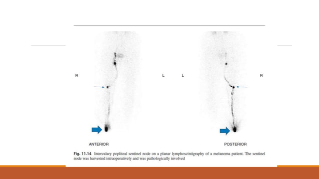 Sentinel node biopsy in oncology a breif overview | PPTX