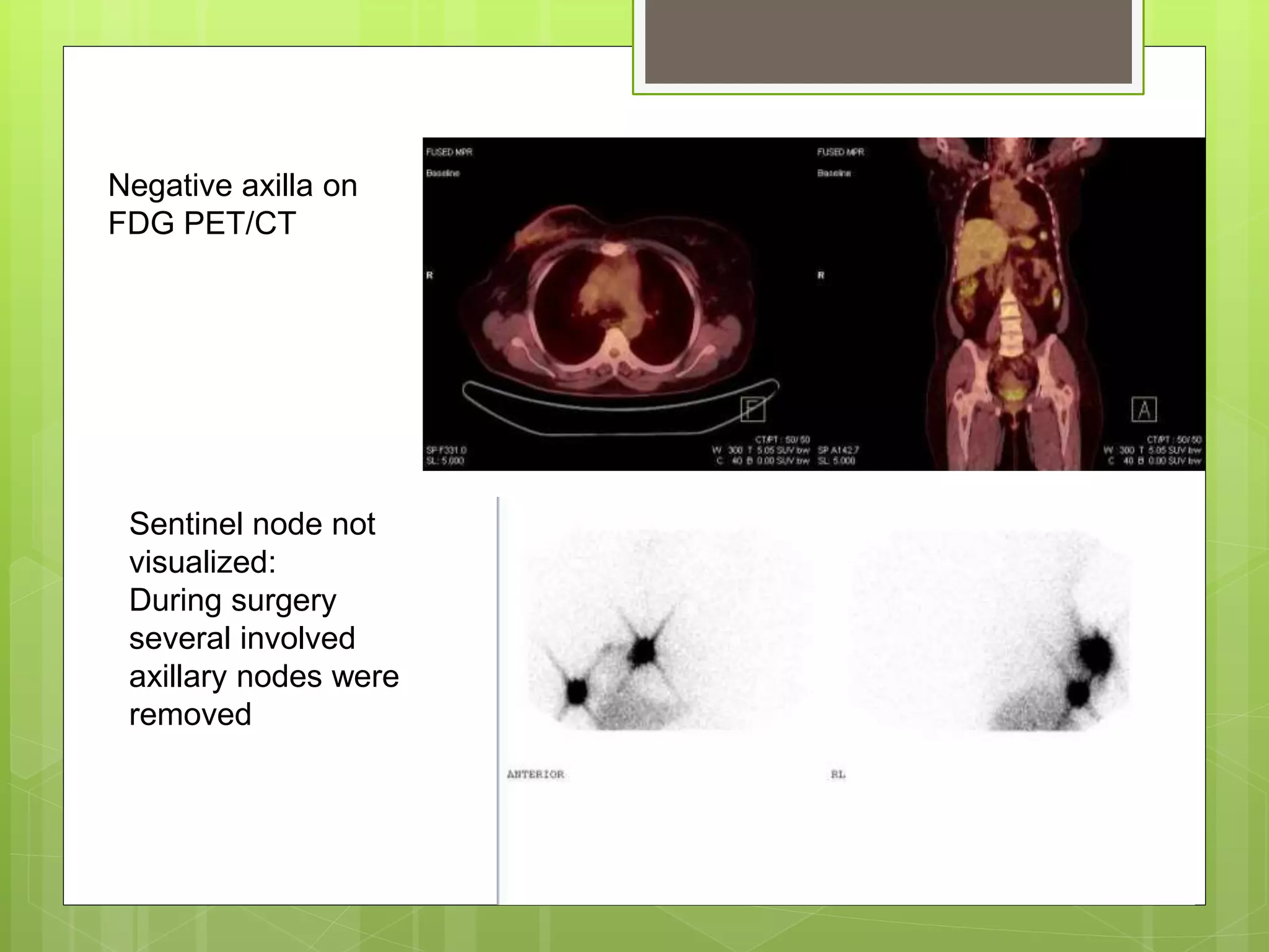 Sentinel Node Mapping In Breast Cancer Controversies Pptx Skin And Dermatology Diseases