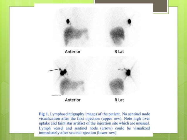 Sentinel Node Mapping In Breast Cancer Controversies Pptx Skin And Dermatology Diseases