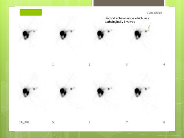 Sentinel Node Mapping In Breast Cancer Controversies