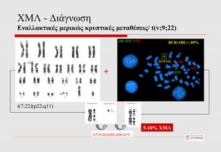 Chronic Myeloid Leukemia (CML) Cytogenetic diagnosis and follow up | PPT