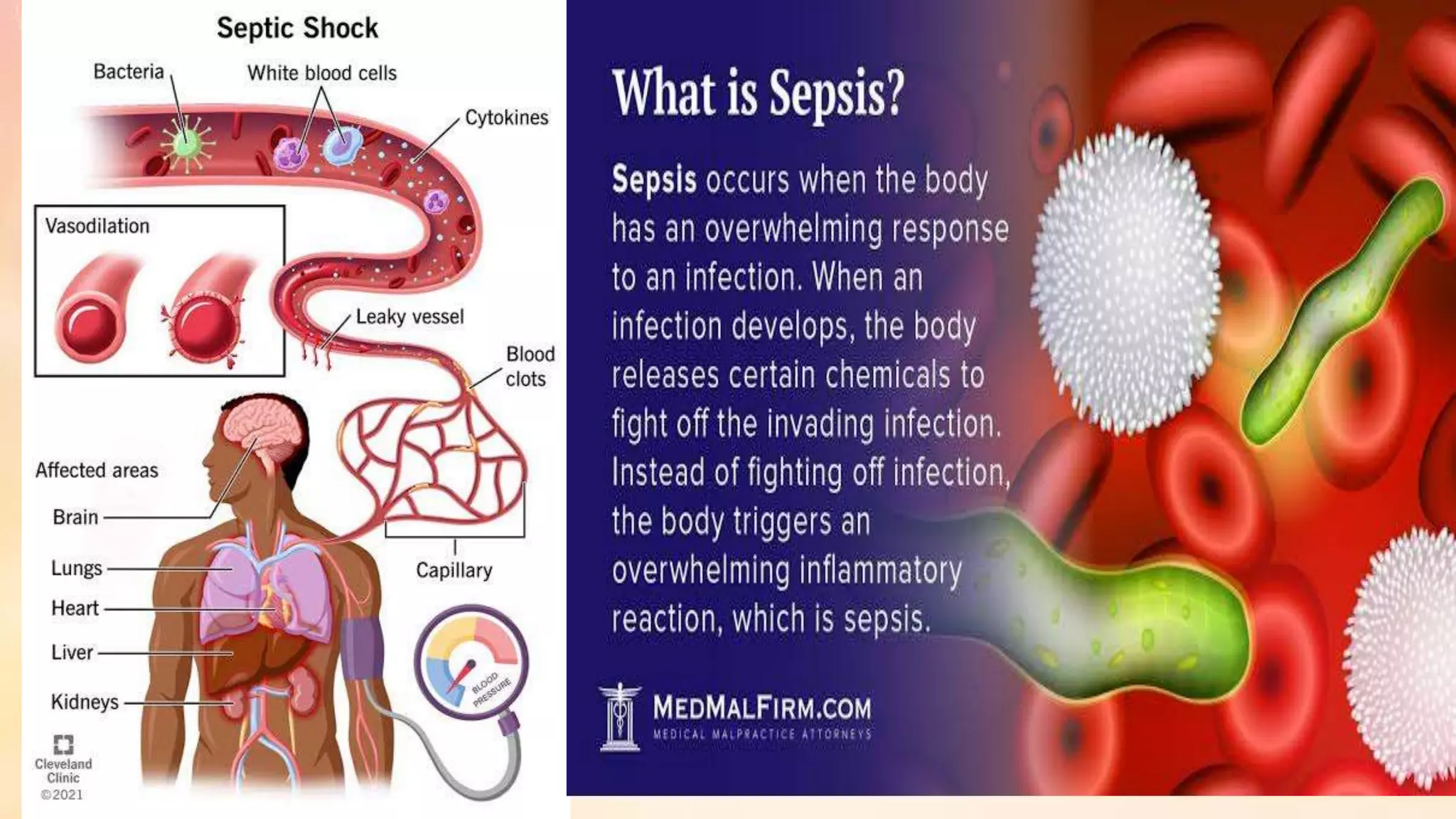 SEPSIS-1.pptx
