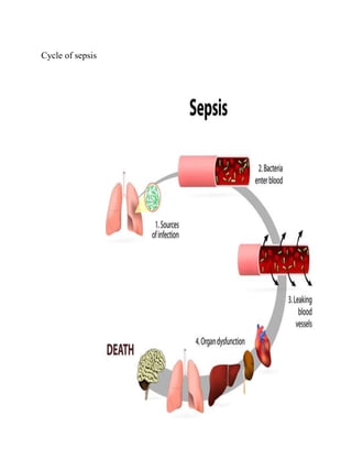 Sepsis ass | PDF