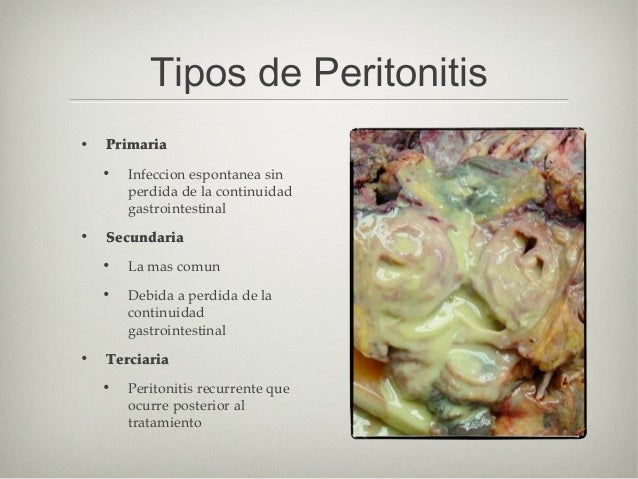 Intra-Abdominal Sepsis | 2013 WSES guidelines for management of intra ...