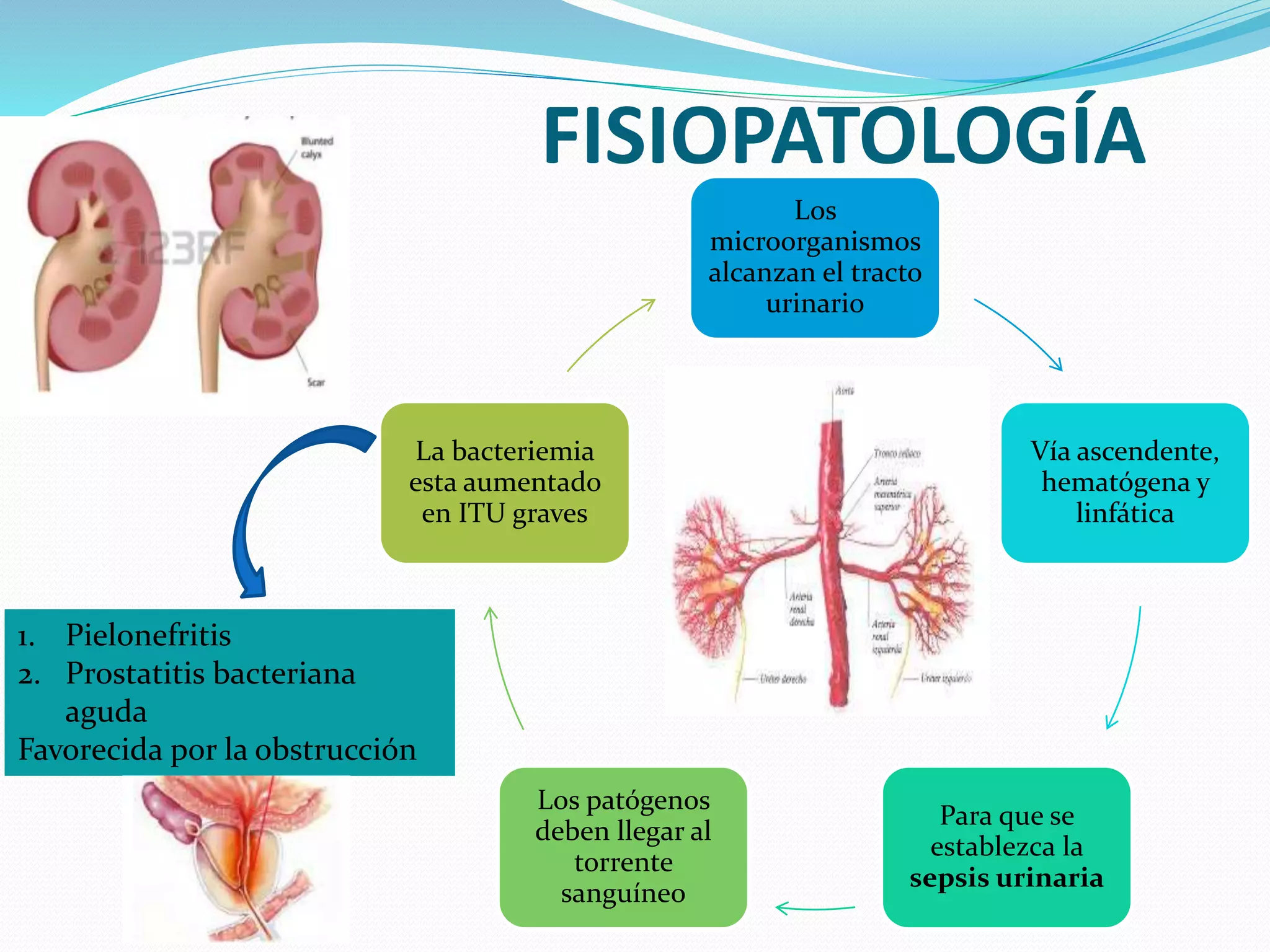 Sepsis urinaria | PPTX
