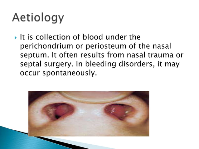 SEPTAL-HAEMATOMA.pptx