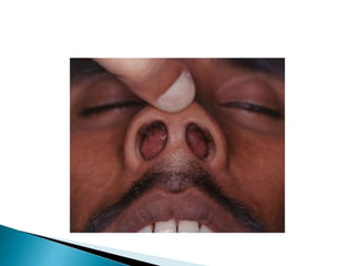 SEPTAL-HAEMATOMA.pptx