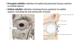 Septal and preseptal orbital cellulitis.pptx