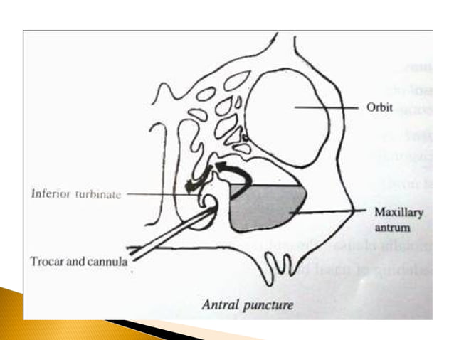 SEPTAL SURGERY & ANTRAL PUNCTURE | PPT | Ear, Nose and Throat ...