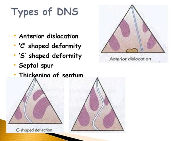 SEPTAL SURGERY & ANTRAL PUNCTURE | PPT | Ear, Nose and Throat ...