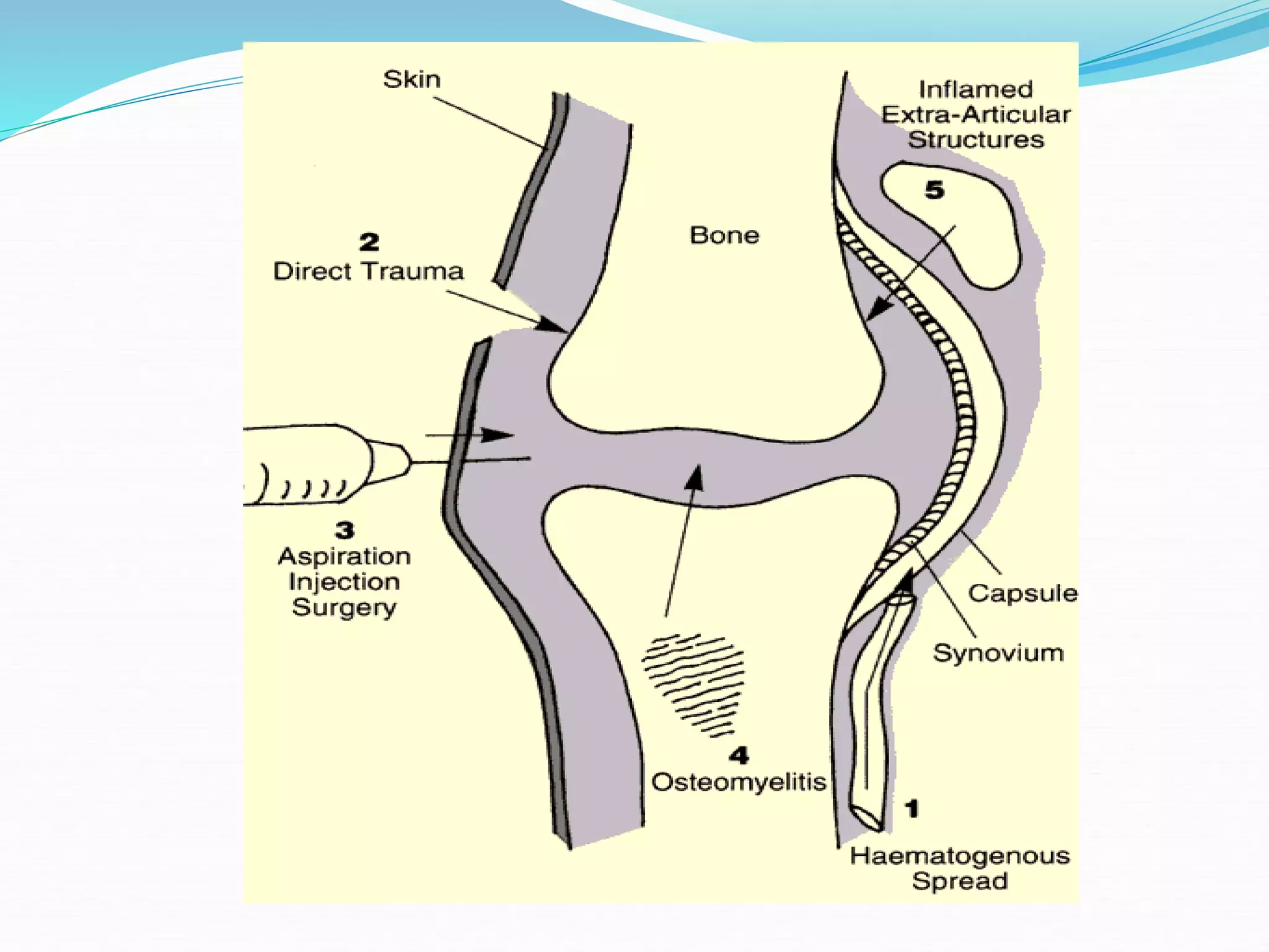 septic-arthritis.ppt