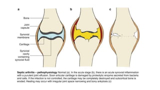 septic arthritis-1.pptx