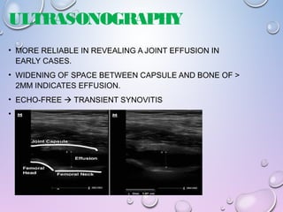 Septicarthritis (inflammation of the joint) | PPT