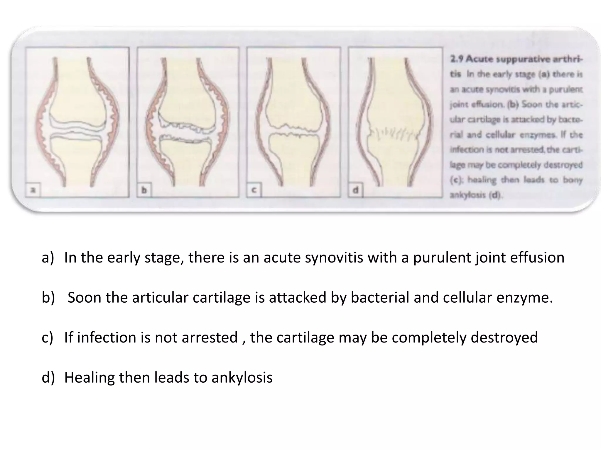 Septic arthritis | PPT