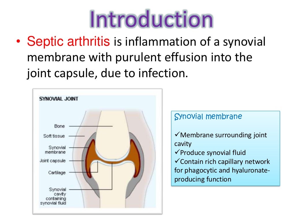 Septic arthritis