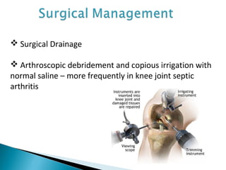 Septicarthritis | PPT