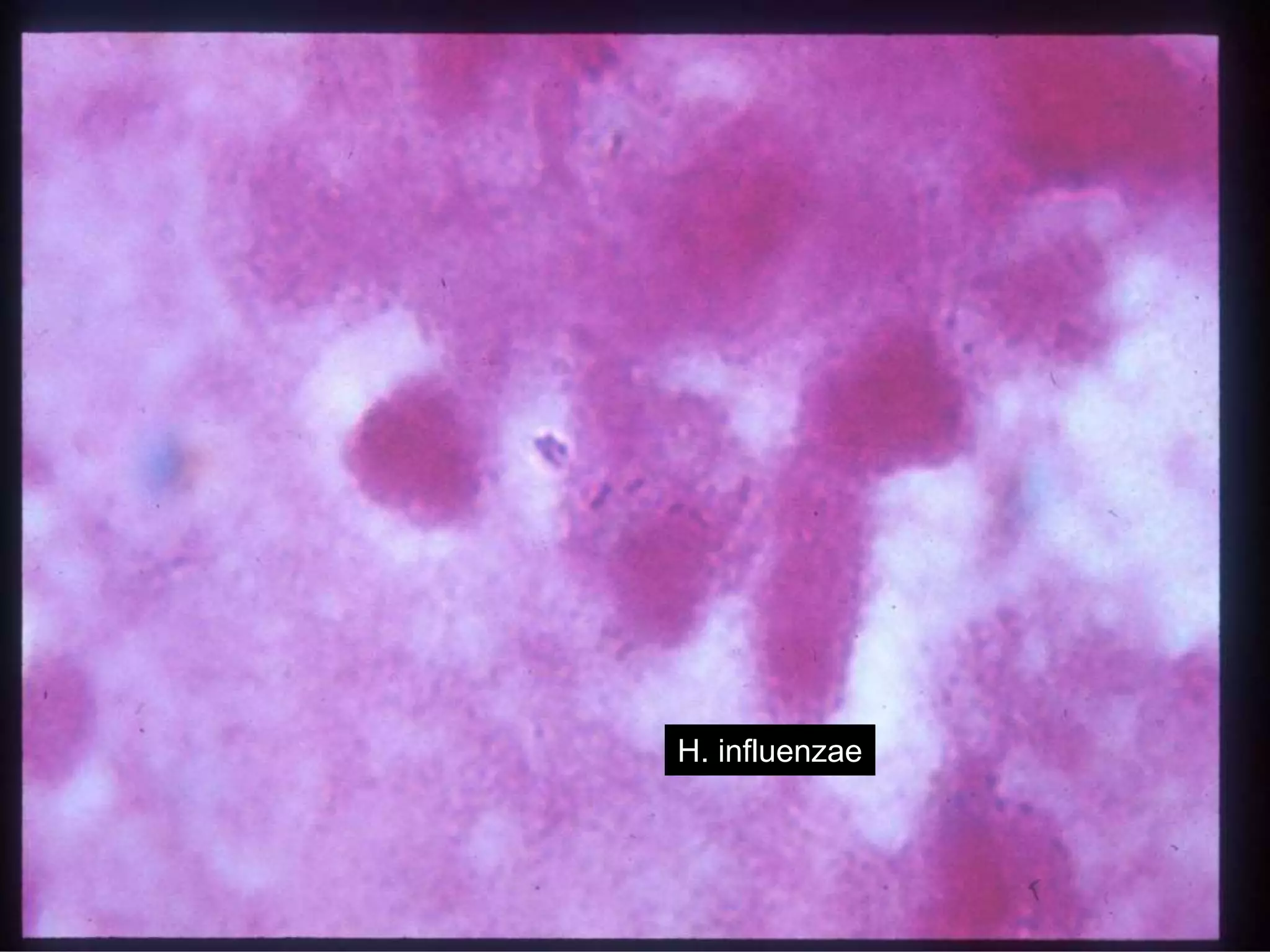 septicarthritis-140504005810-phpapp01.pdf