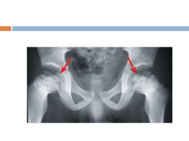 septicarthritis-140504005810-phpapp01.pdf | Bone and Joint Conditions ...