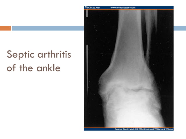 septicarthritis-140504005810-phpapp01.pdf | Bone and Joint Conditions ...