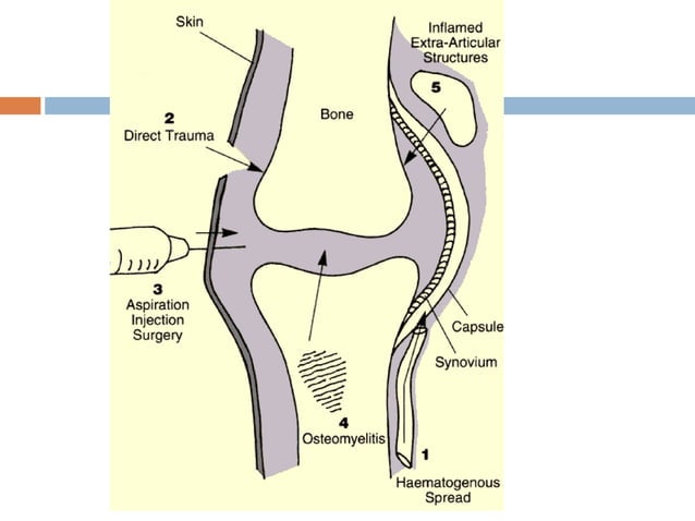 septicarthritis-140504005810-phpapp01.pdf | Bone and Joint Conditions ...