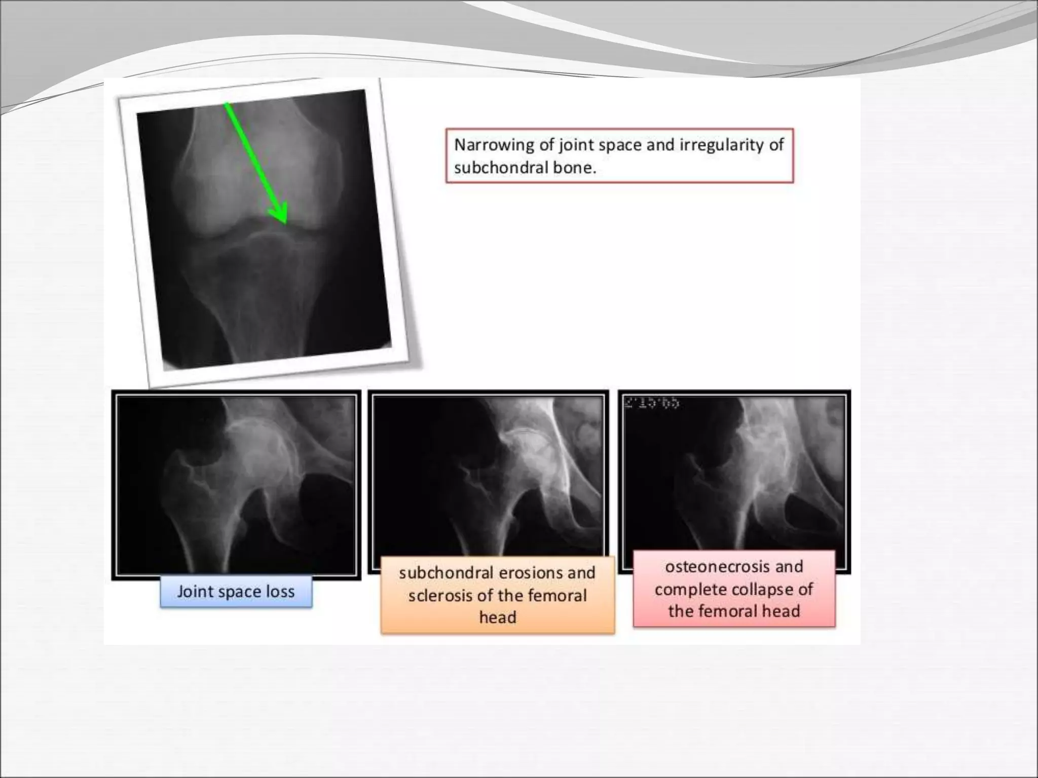 Septic arthritis | PPT