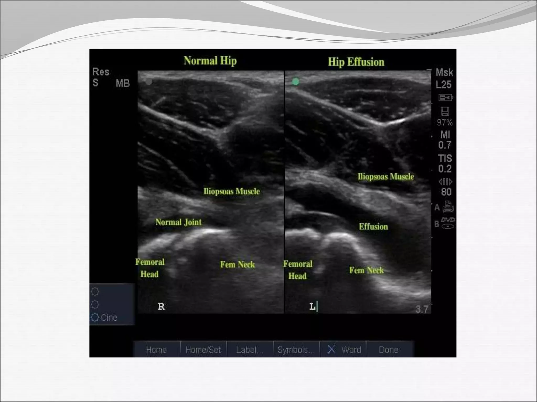 Septic arthritis | PPT