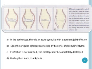 Septic arthritis | PPT