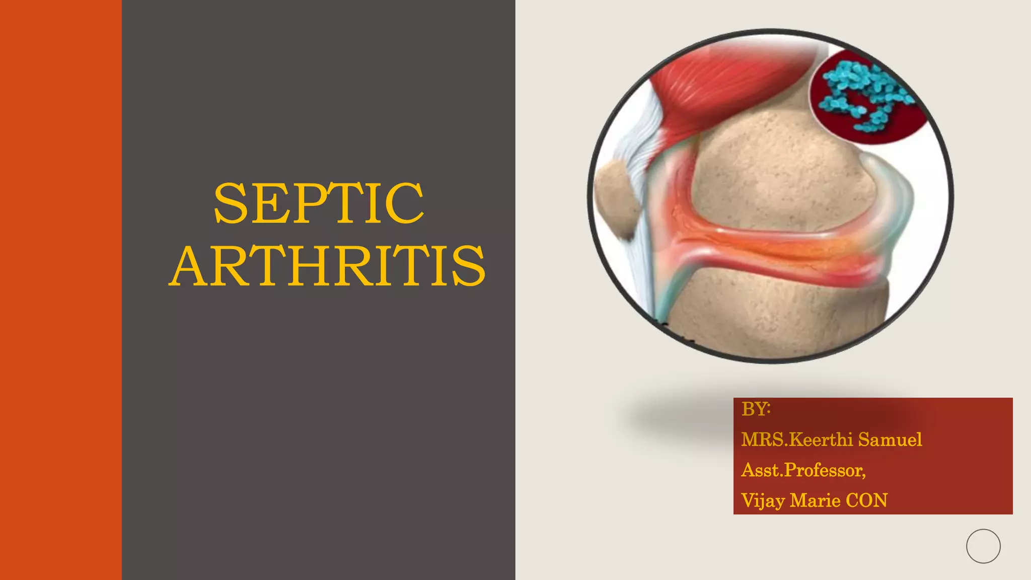 Septic arthritis | PPTX