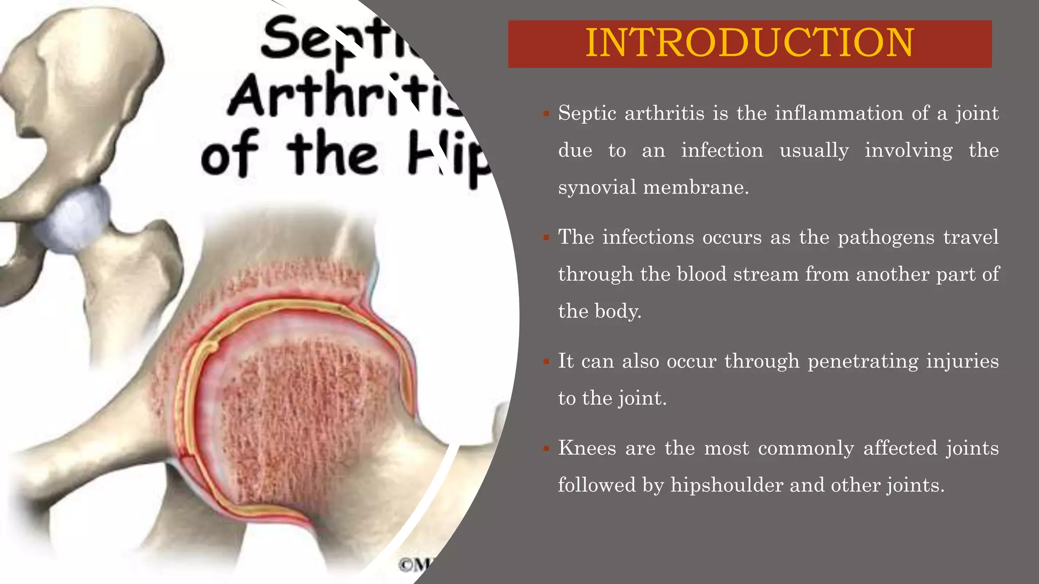 Septic arthritis | PPTX
