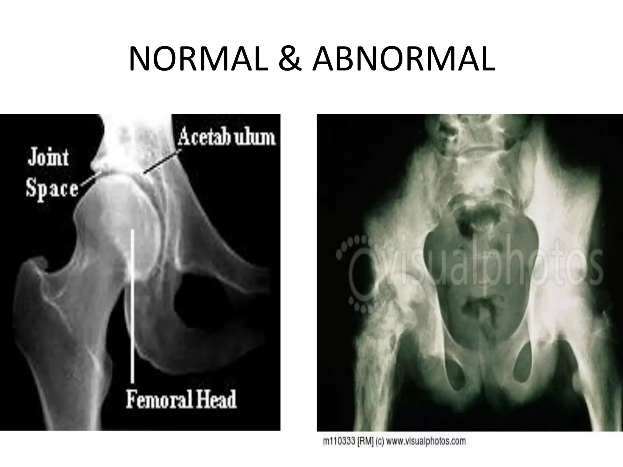 Septic Arthritis | PPTX | Bone and Joint Conditions | Diseases and ...