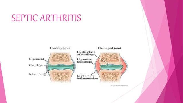SEPTIC ARTHRITIS.pptx | Bone and Joint Conditions | Diseases and Conditions