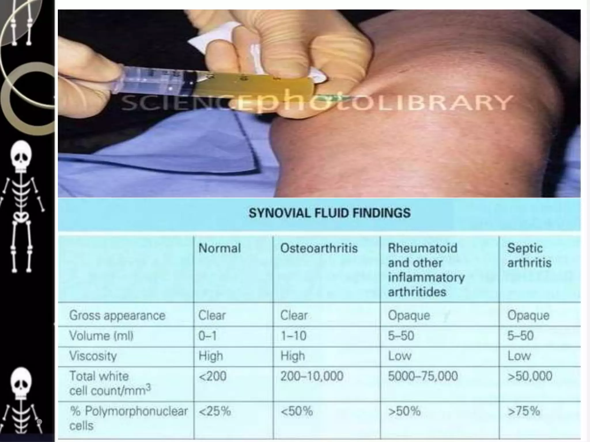 septic arthritis.pptx