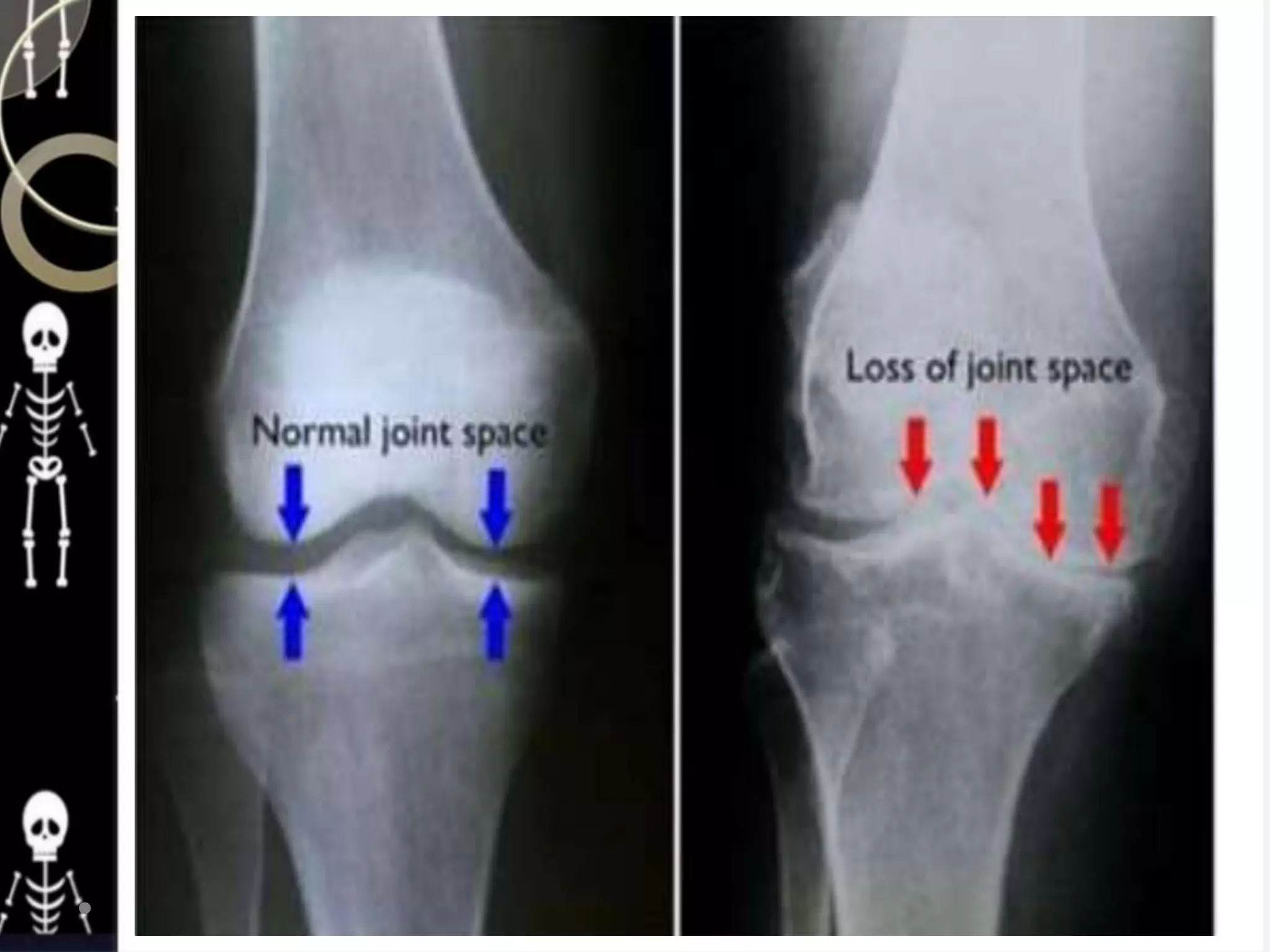septic arthritis.pptx