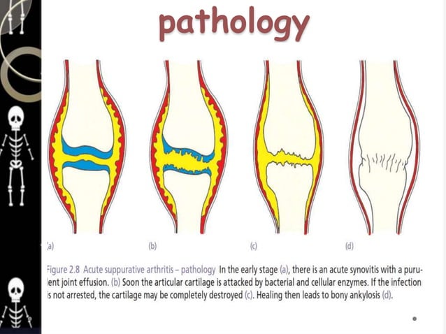septic arthritis.pptx