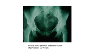 Septic Arthritis.ppthbbgmknmmnjjnbhsijst | PPT