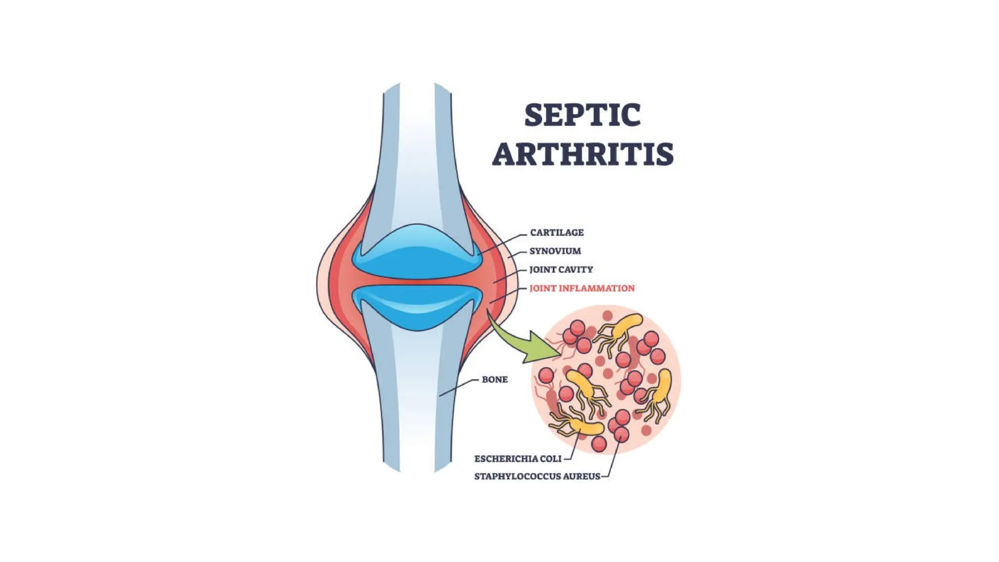 Septic Arthritis orthopedic non trauma.ppt