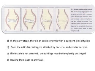 Septic arthritis | PPT