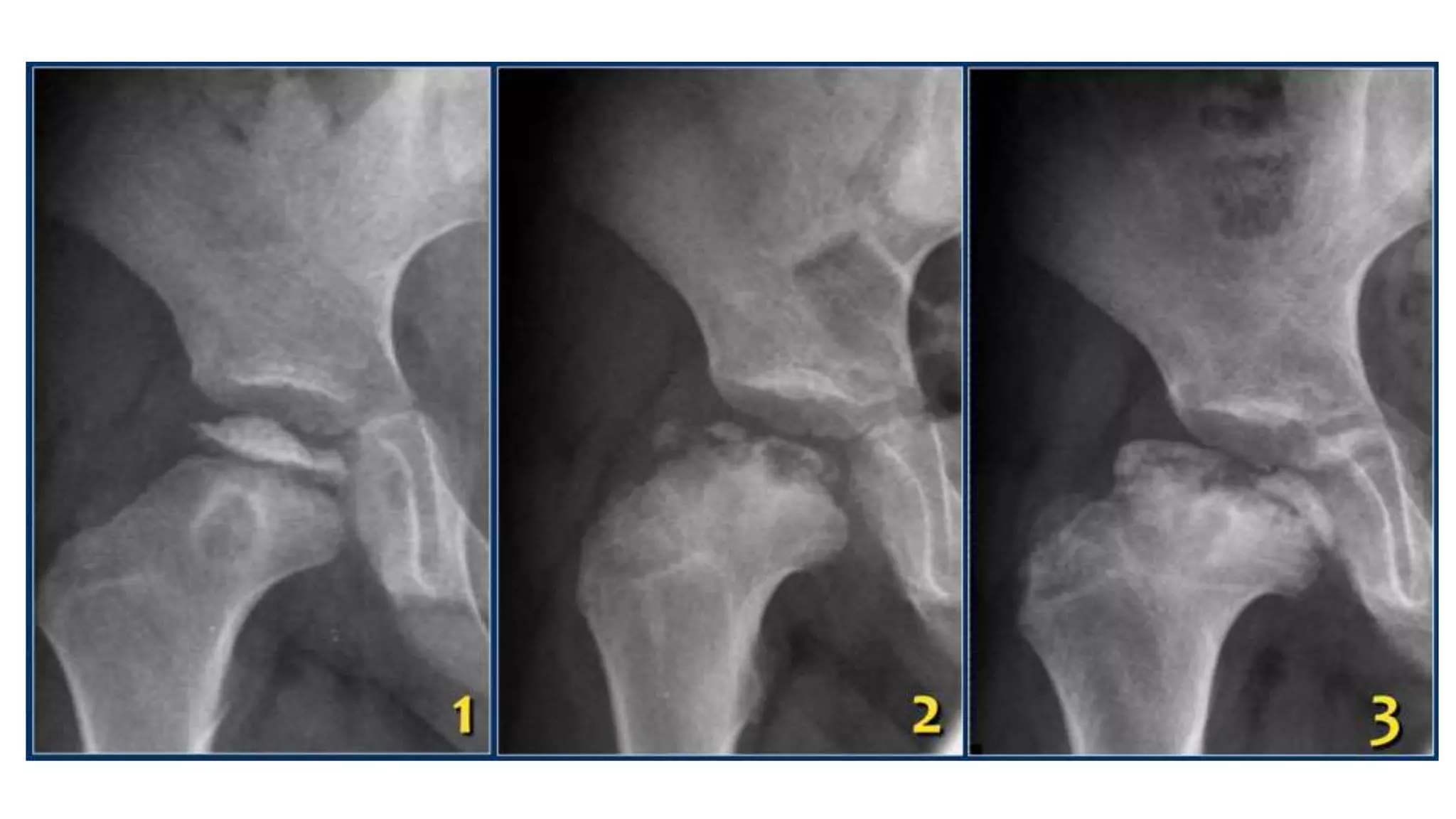 Septic arthritis and sequelae | PPTX
