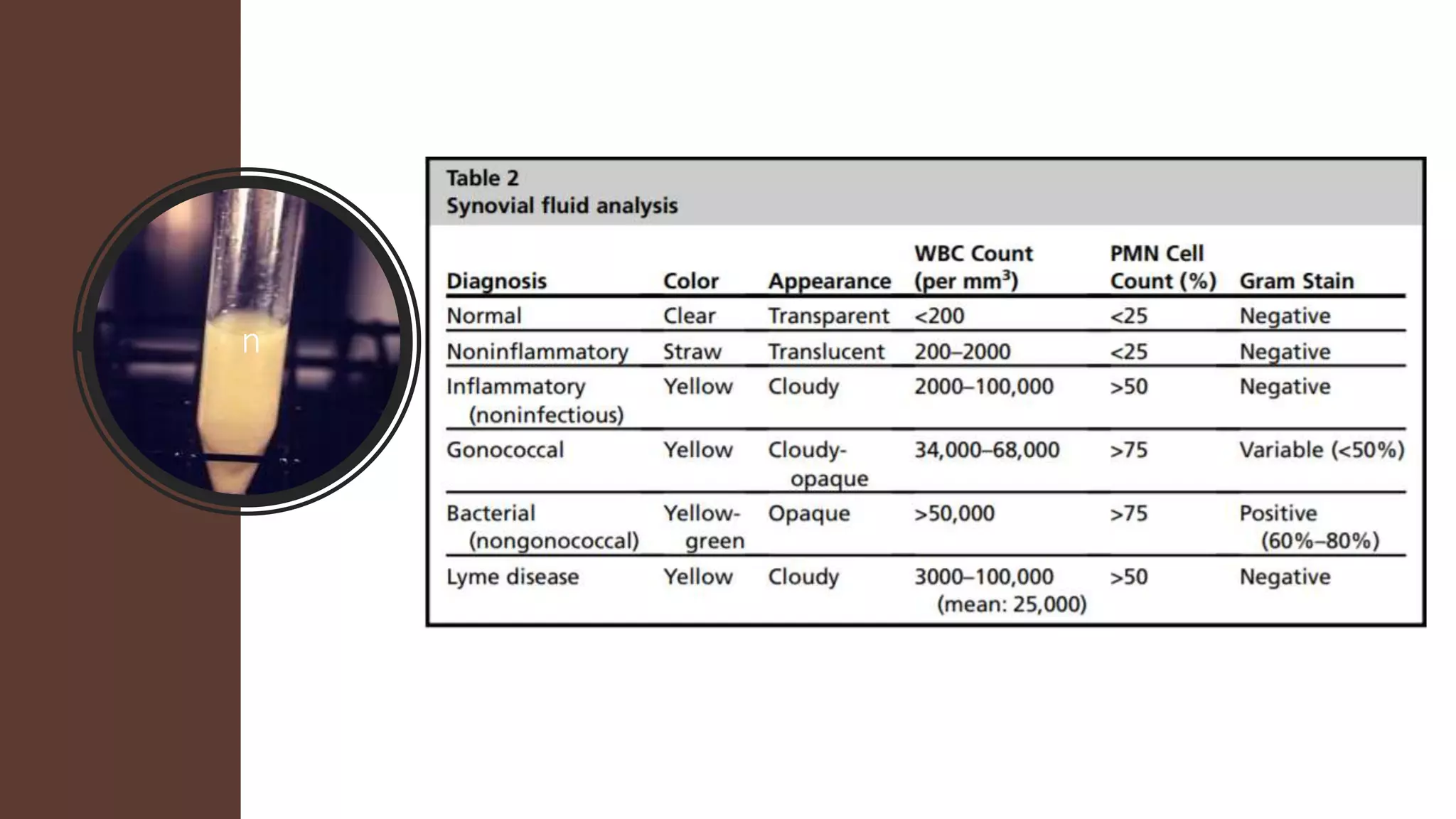 Septic arthritis and sequelae | PPTX