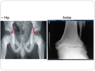 Septic arthritis in children | PPTX