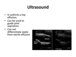 Septic Arthritis of hip in children.pptx