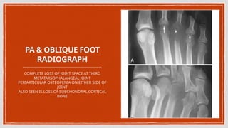 SEPTIC ARTHRITIS & OSTEOMYELITIS IMAGINGIS.pptx