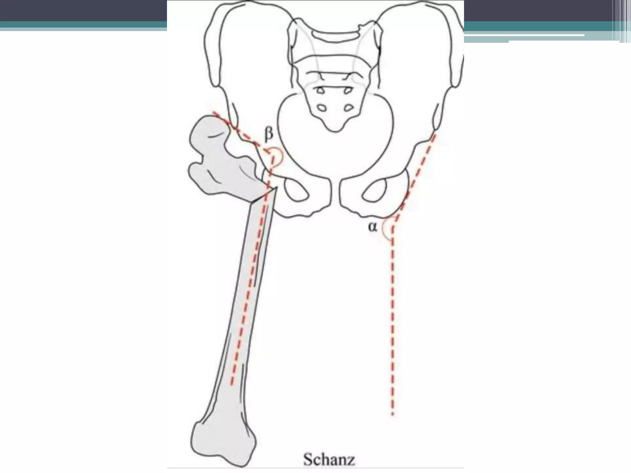 Septic arthritis sequelae. | PPTX