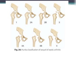 Septic arthritis sequelae. | PPTX